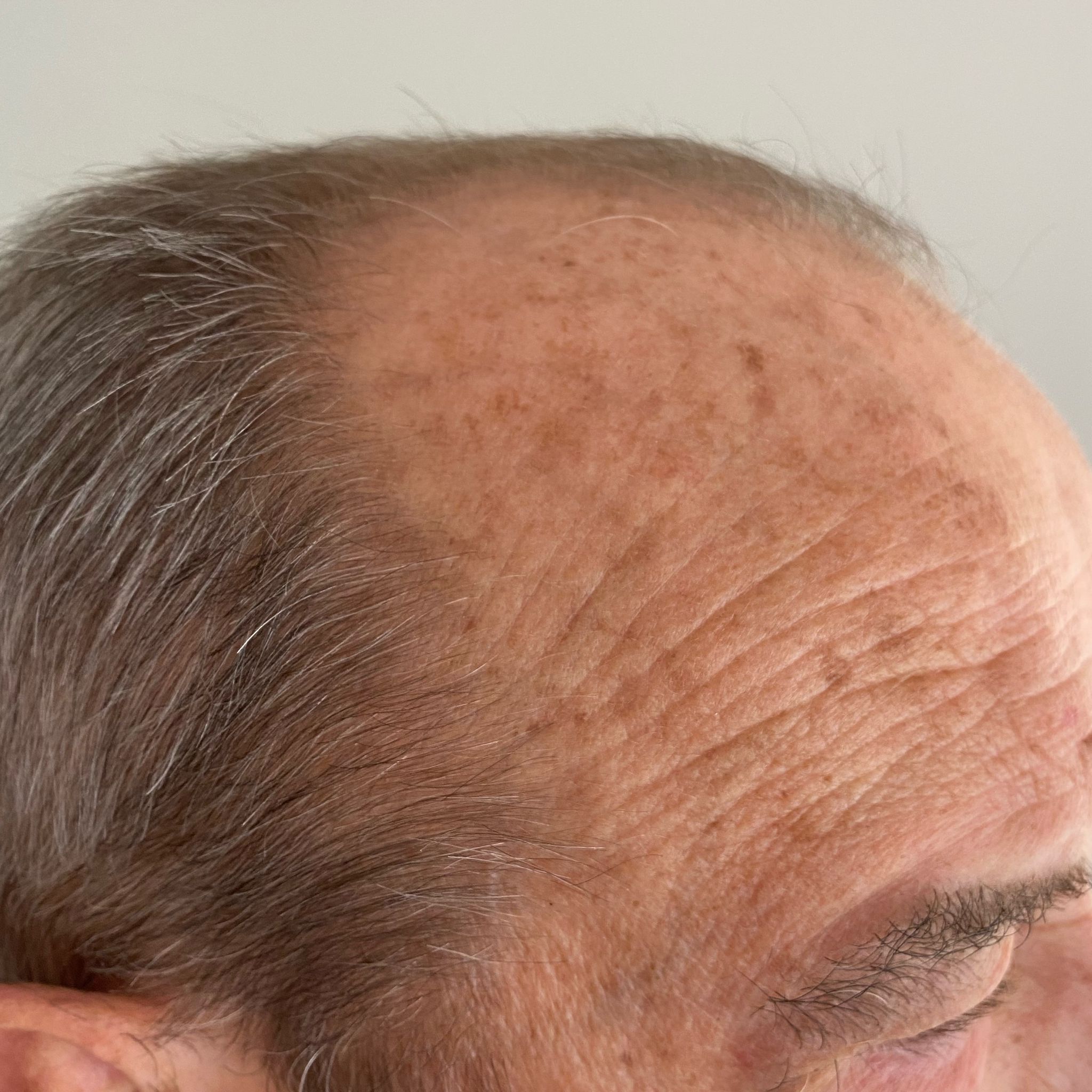 Cómo prevenir las manchas en la piel: todos mis trucos - Dermamurcia