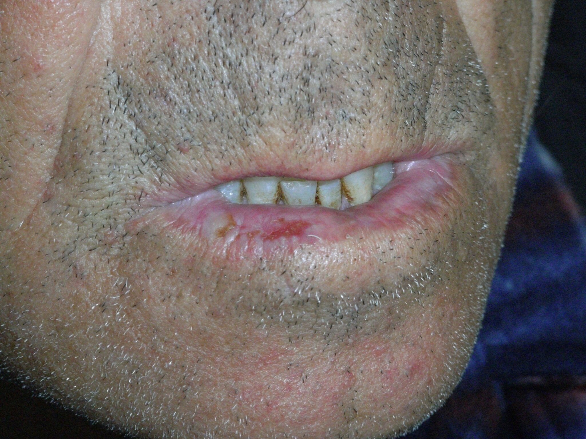 Por qué tengo siempre los labios secos y agrietados - Dermamurcia