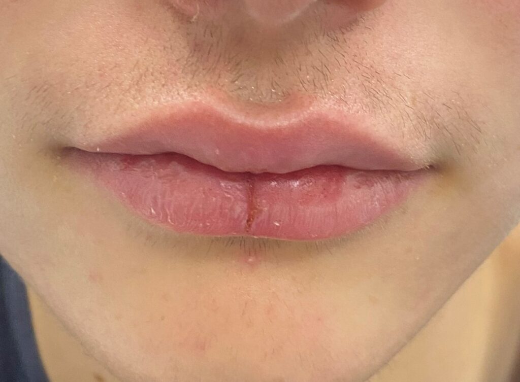 Por qué tengo siempre los labios secos y agrietados - Dermamurcia