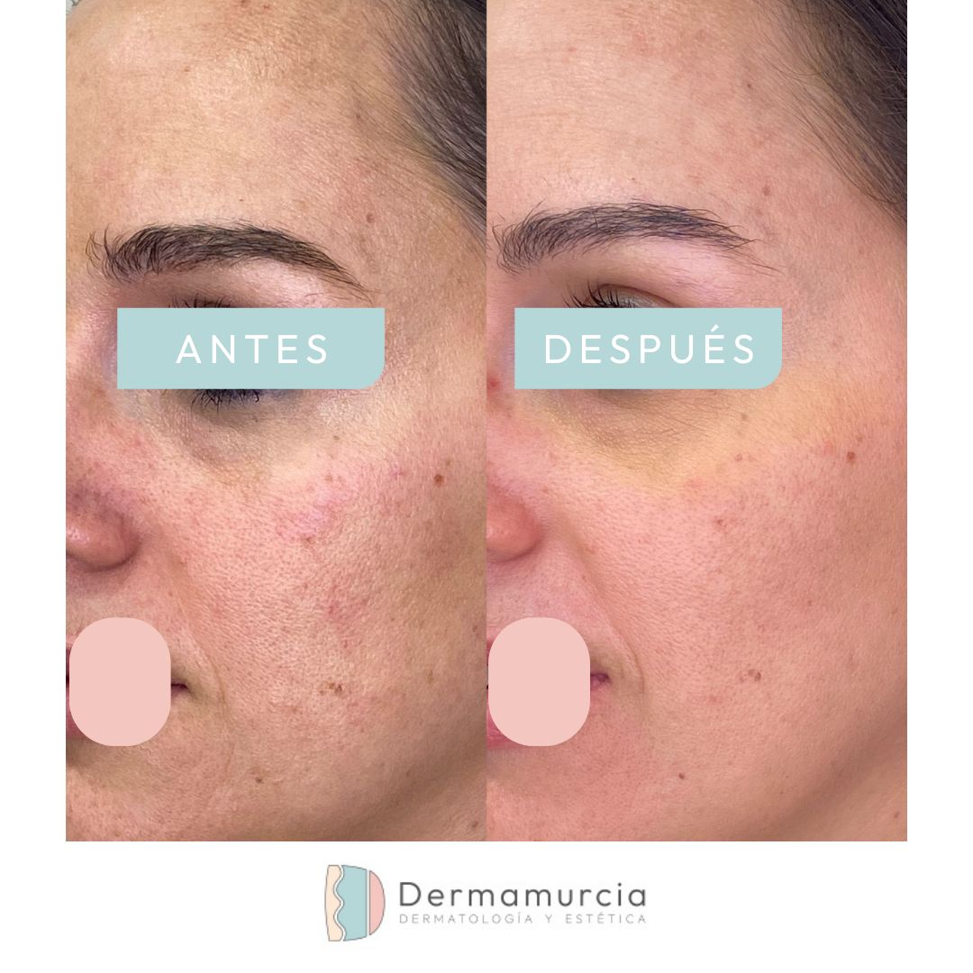 Tengo la cara roja: las causas más frecuentes